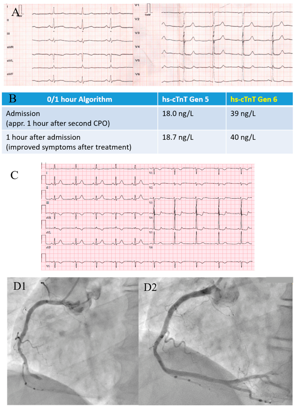 Clinical Gray Zones of Cardiac Troponin Interpretation in the Emergency ...