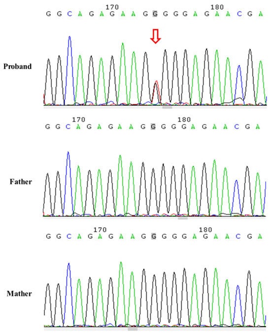Clinical Features and Gene Mutation of Neonatal Seizures