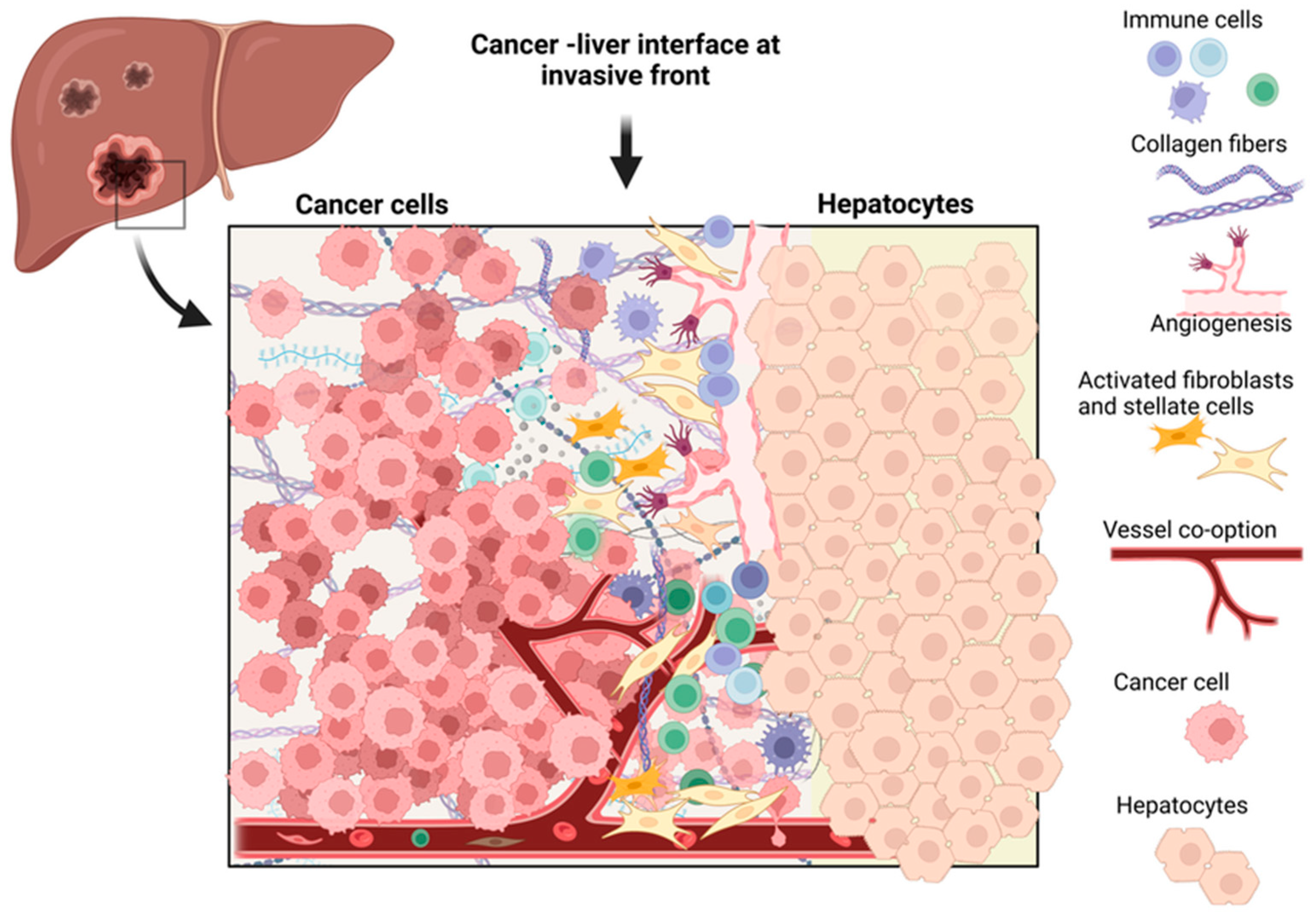 Critical Prognostic and Predictive Factors in Colorectal Liver ...