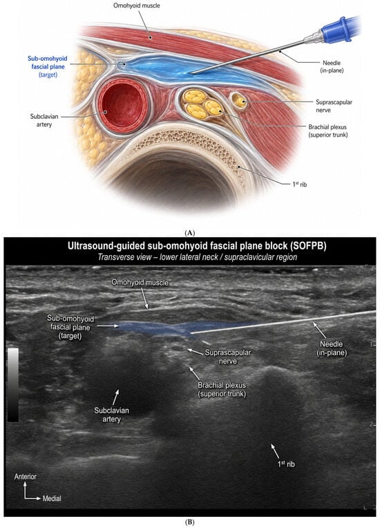 Sub-Omohyoid Fascial Plane Block as a Diaphragm-Sparing Approach for ...
