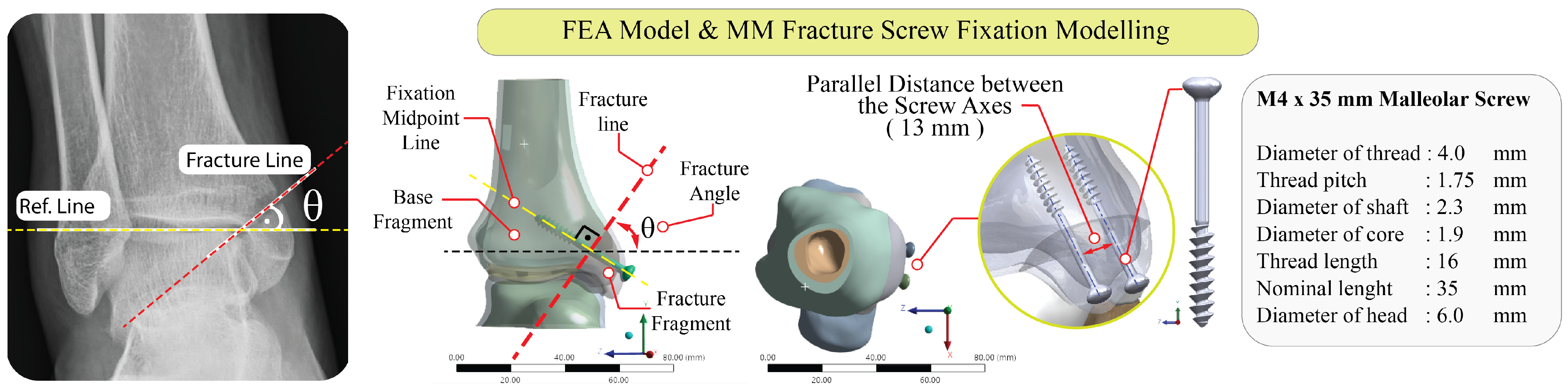 Medial Malleolar Fracture Fixation with Stainless Steel, Titanium ...