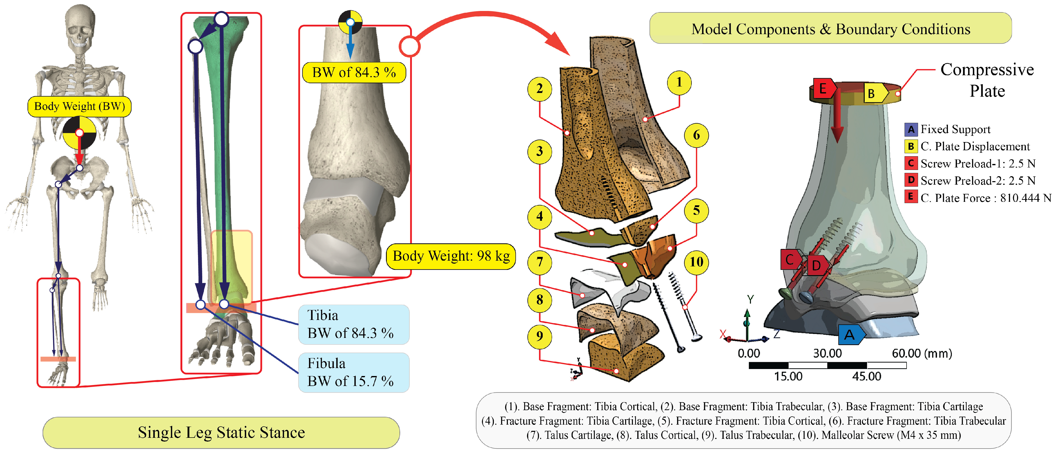 Medial Malleolar Fracture Fixation with Stainless Steel, Titanium ...