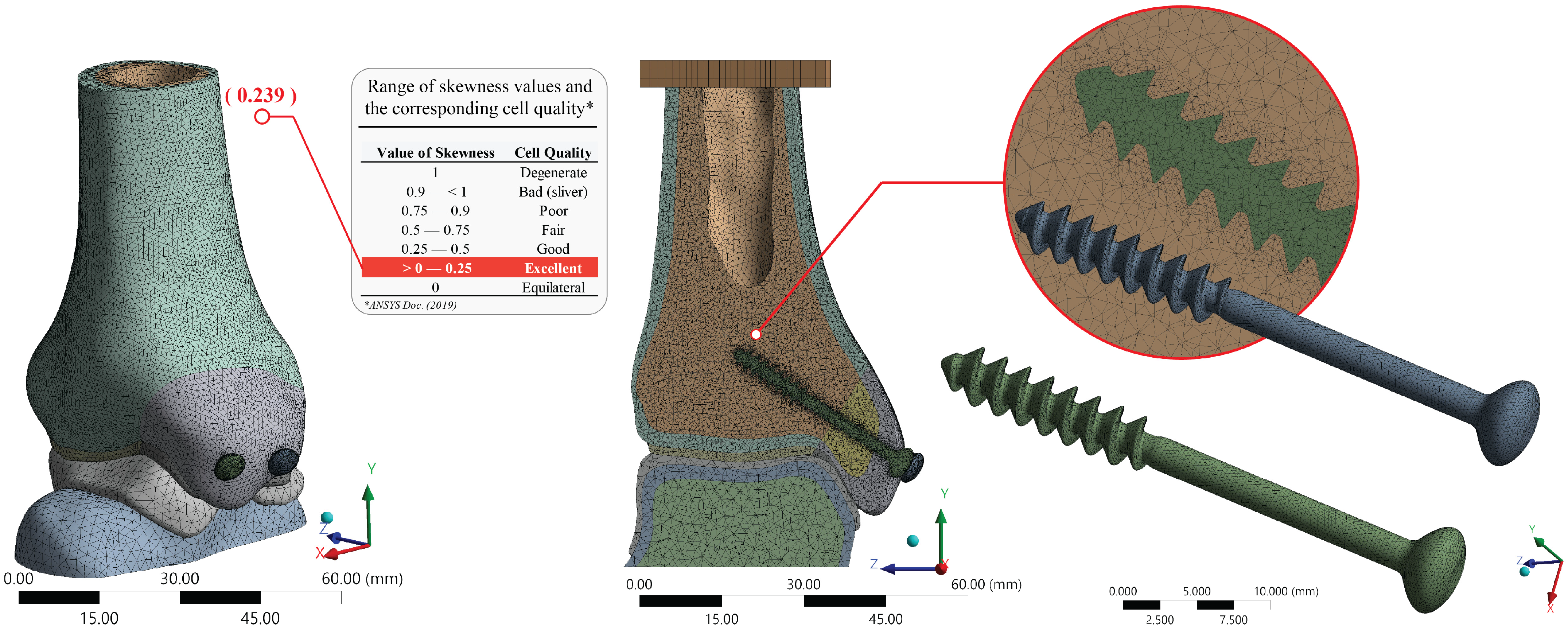 Medial Malleolar Fracture Fixation with Stainless Steel, Titanium ...