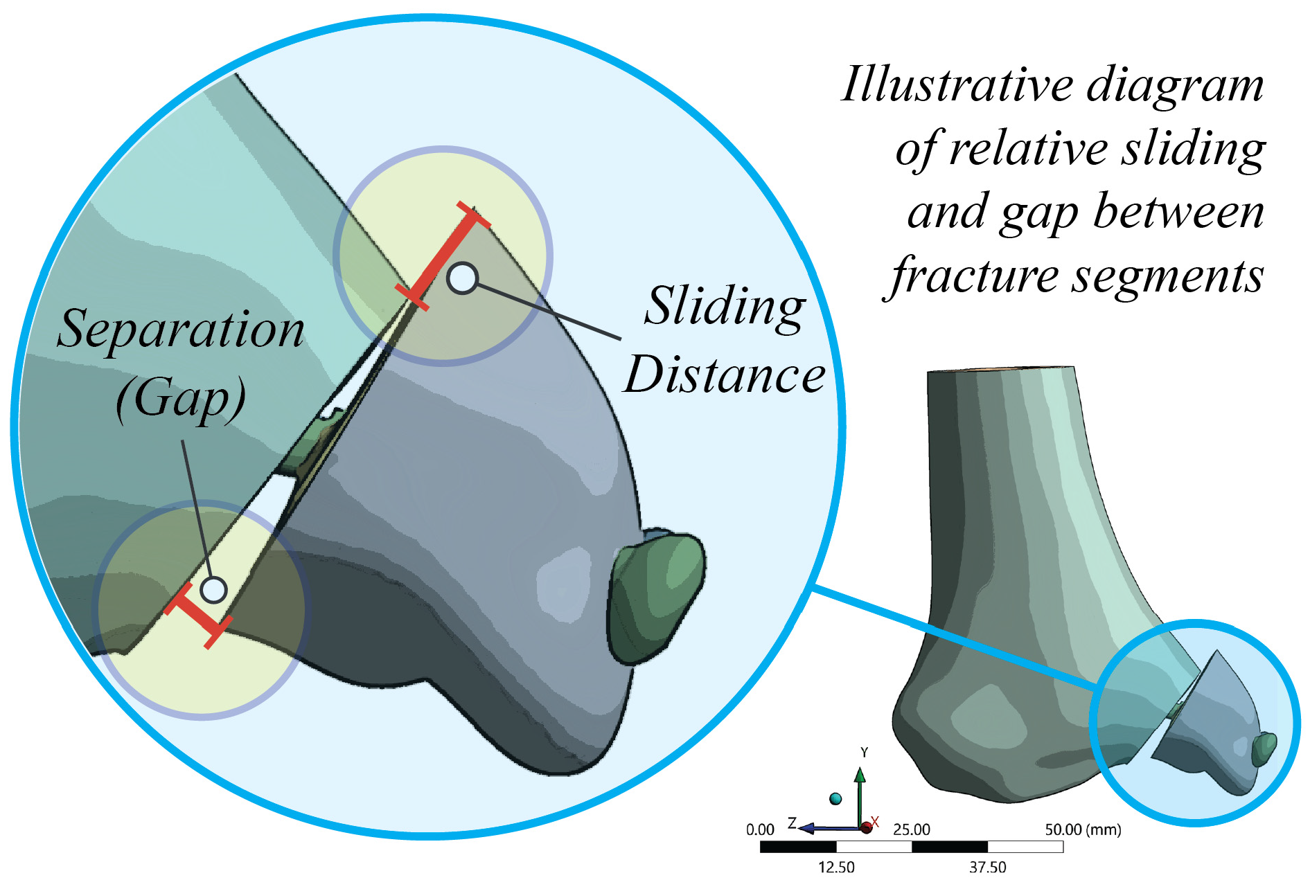 Medial Malleolar Fracture Fixation with Stainless Steel, Titanium ...