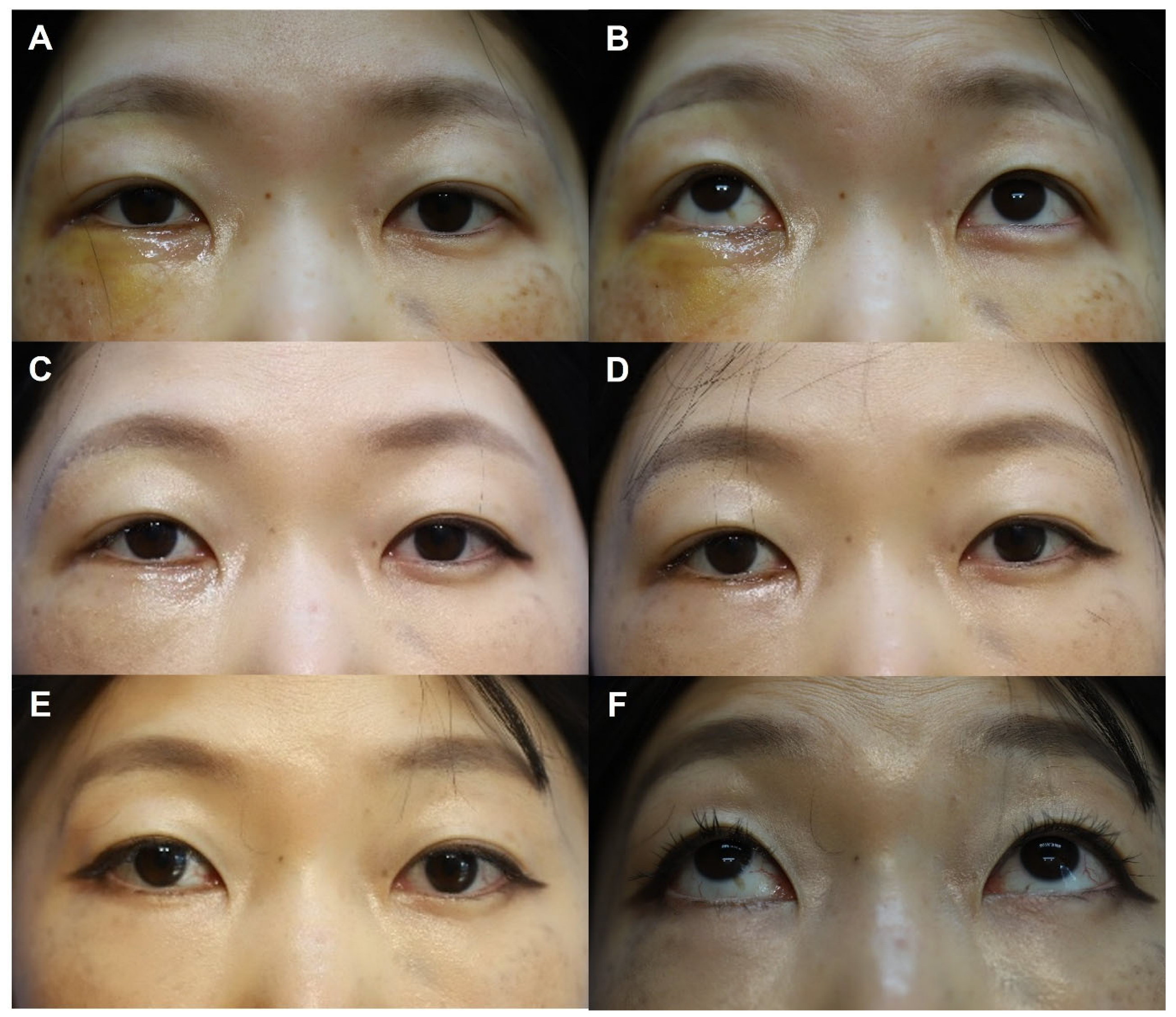 Acellular Dermal Matrix (WITHderm®) Spacer Grafts for the Prevention of ...