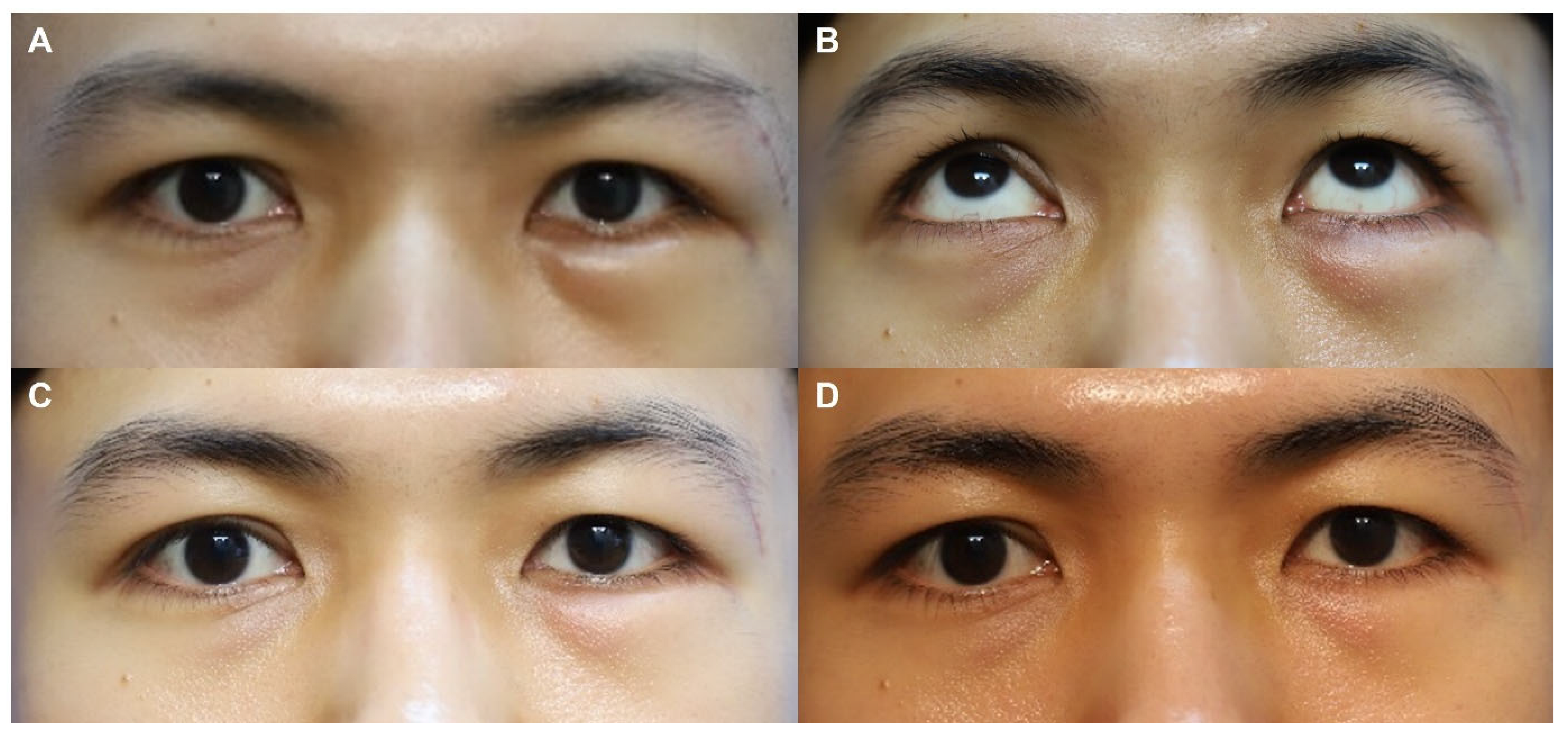Acellular Dermal Matrix (WITHderm®) Spacer Grafts for the Prevention of ...