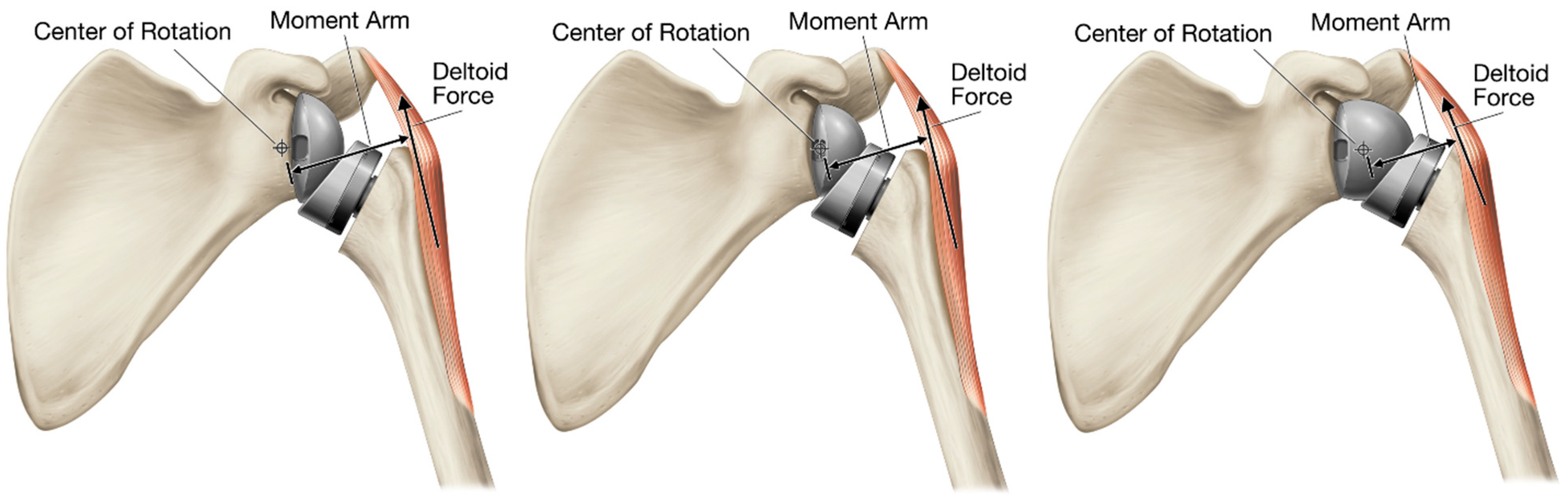 Mechanical Shoulder Prosthesis Mechanical Shoulder Prosthesis