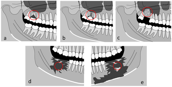 Texture Analysis in Volumetric Imaging for Dentomaxillofacial Radiology ...