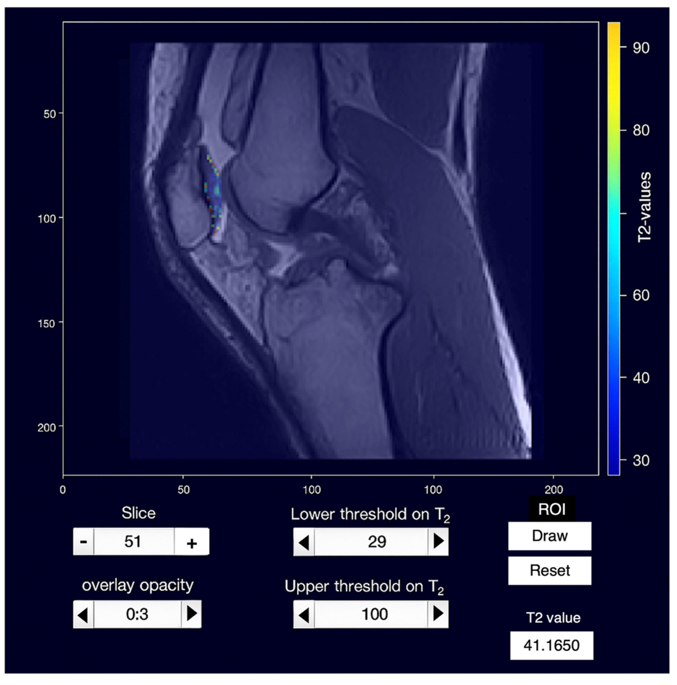 Knee Cartilage Quantification: Performance of Low-Field MR in Detecting ...
