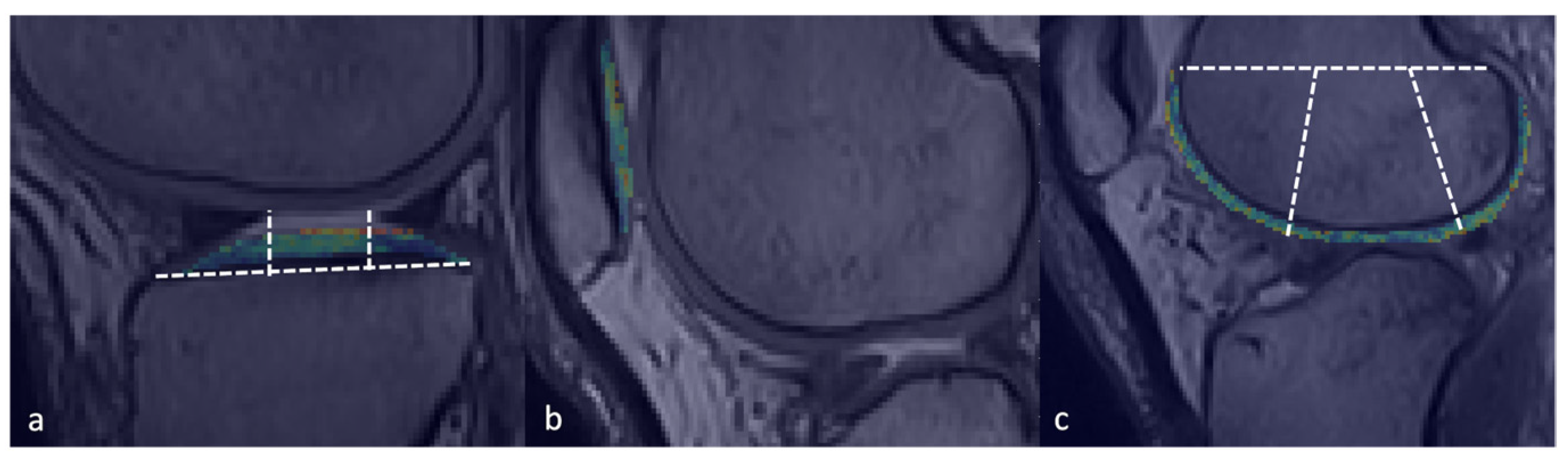 Knee Cartilage Quantification: Performance of Low-Field MR in Detecting ...