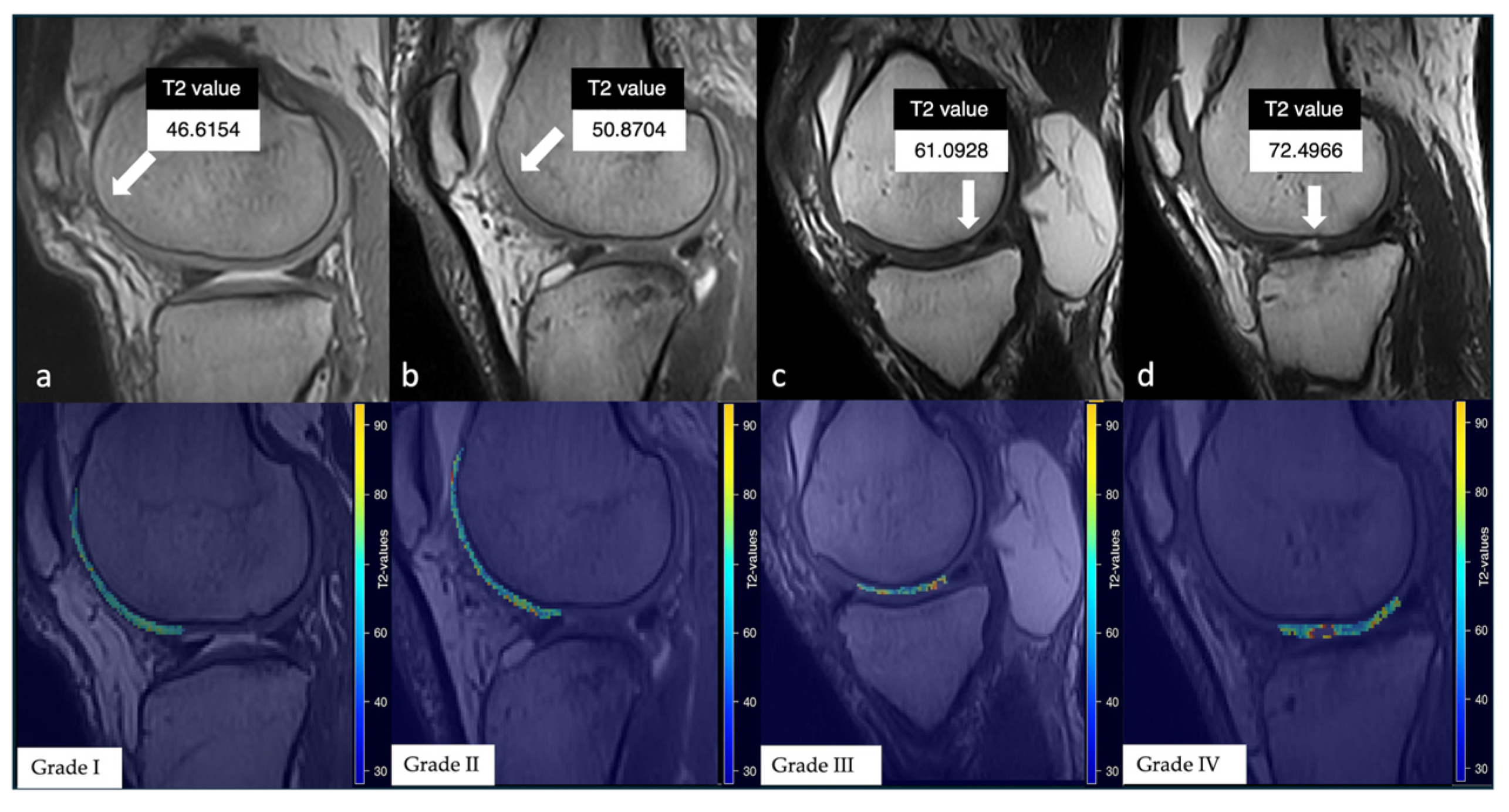 Knee Cartilage Quantification: Performance of Low-Field MR in Detecting ...