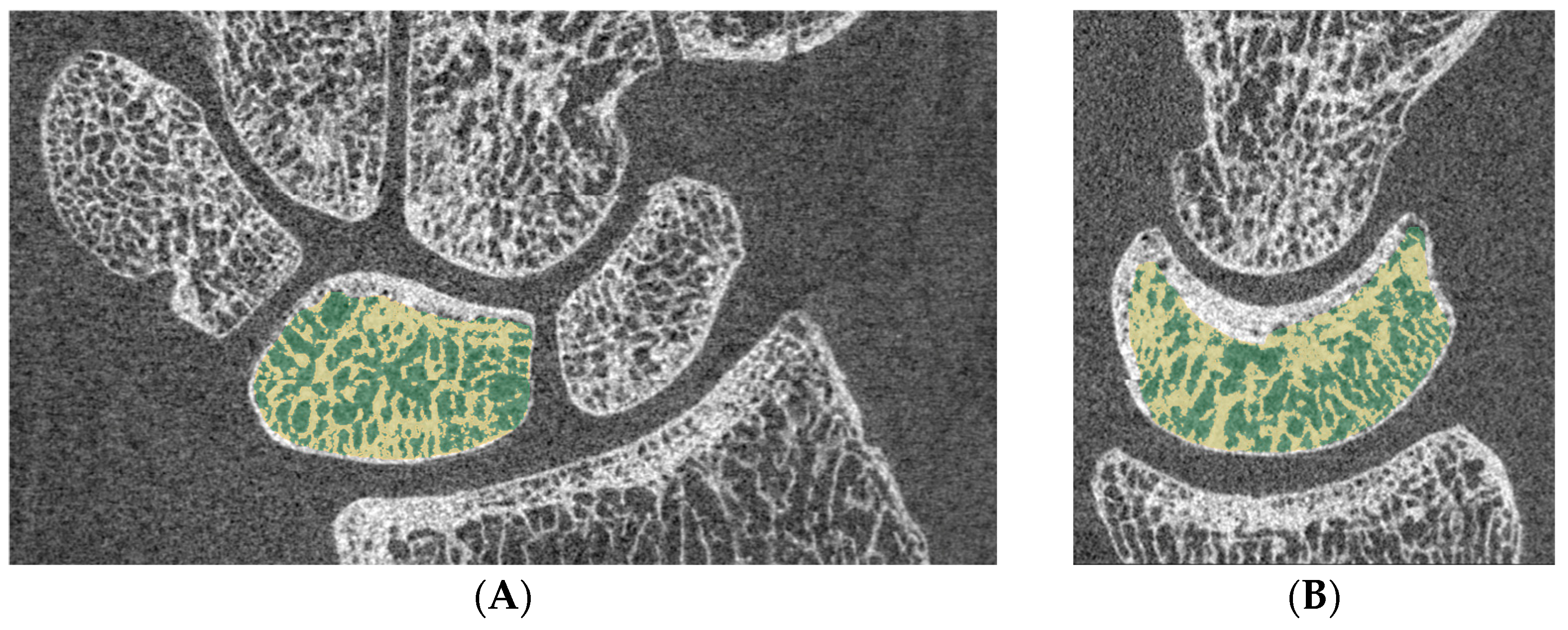 High-Resolution Peripheral Quantitative Computed Tomography (HR-pQCT) for Assessment of ...