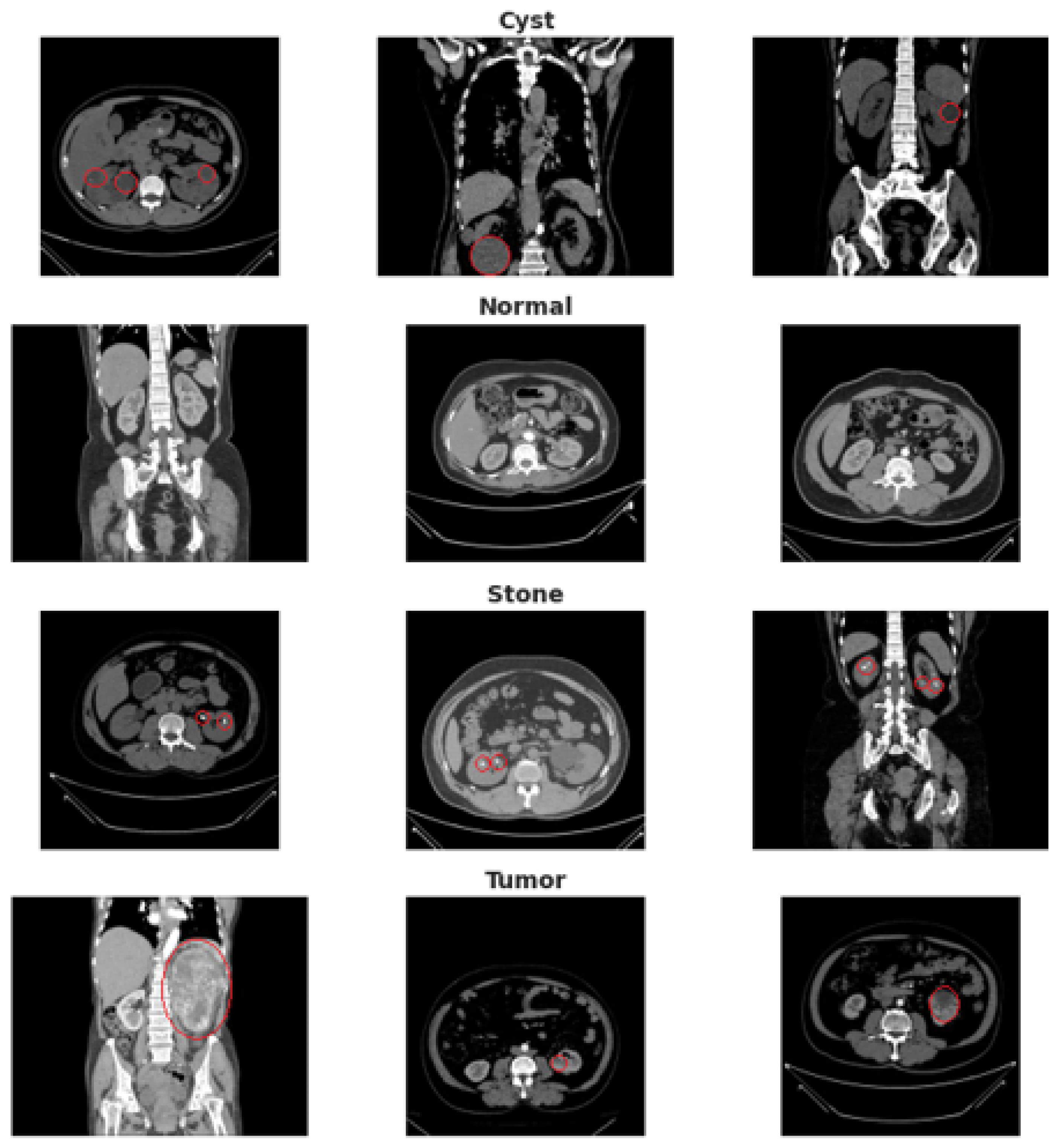 DiagNeXt: A Two-Stage Attention-Guided ConvNeXt Framework for Kidney Pathology Segmentation and ...