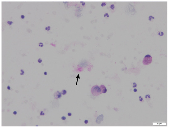 Detection of Pneumocystis jirovecii in Patients with Severe COVID-19 ...