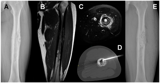 Bone and Joint Infections: The Role of Imaging in Tailoring Diagnosis ...