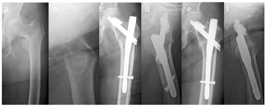 Effectiveness of Cement Augmentation on Early Postoperative Mobility in ...