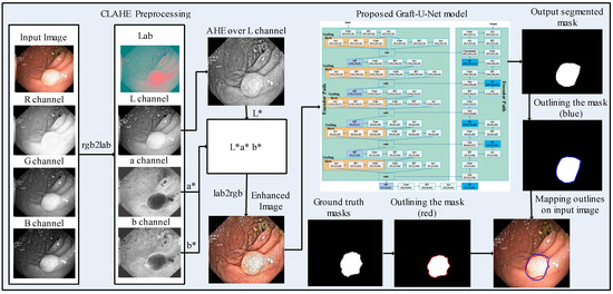 Gastrointestinal Tract Polyp Anomaly Segmentation on Colonoscopy Images ...