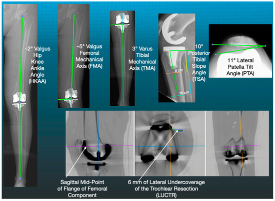 JPM | Free Full-Text | Six Commonly Used Postoperative Radiographic ...