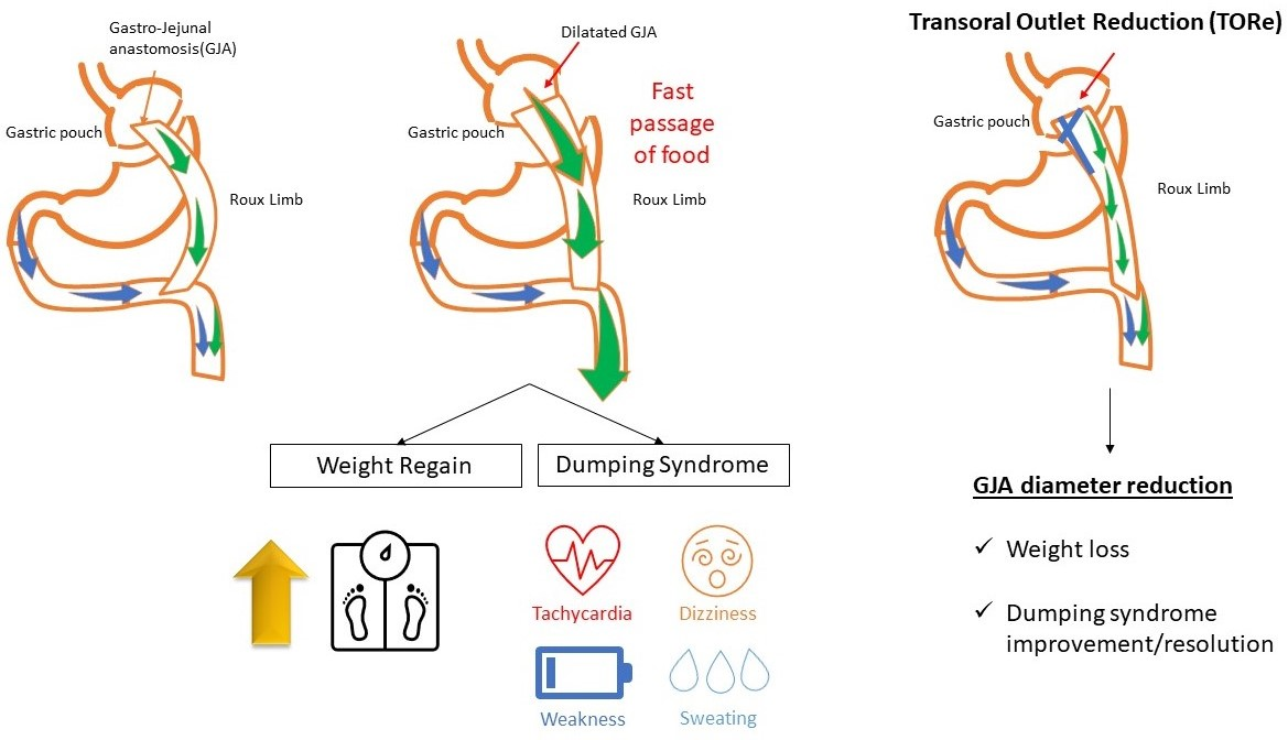 Dumping Syndrome Dumping Syndrome