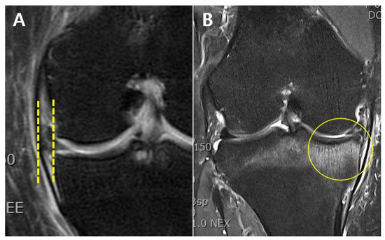Age and Meniscal Extrusion Are Determining Factors of Osteoarthritis ...