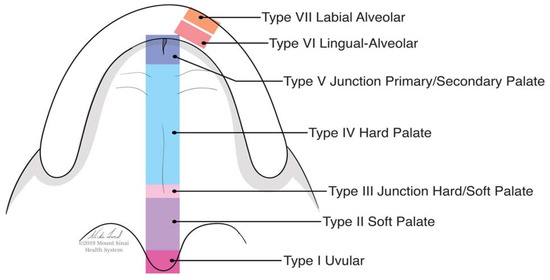 Evaluation of a Novel Technique for Closure of Small Palatal Fistula