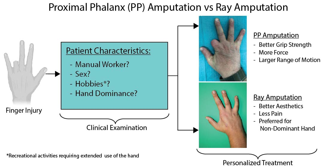 Traumatic Amputation Traumatic Amputation