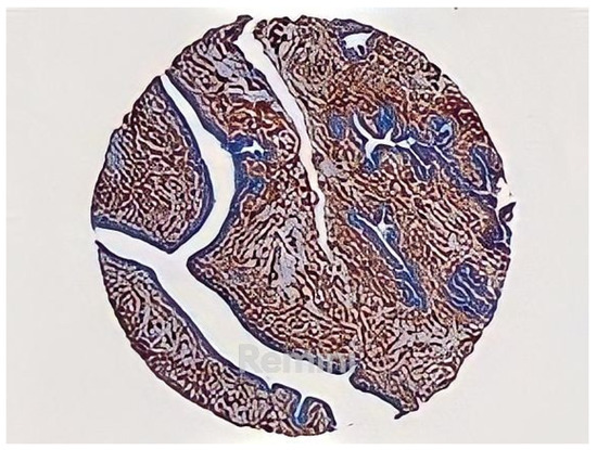 Automated Lung Cancer Segmentation in Tissue Micro Array Analysis ...