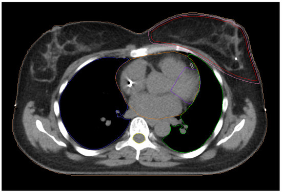 Radiation Dose to Critical Cardiac Structures from Three-Dimensional ...