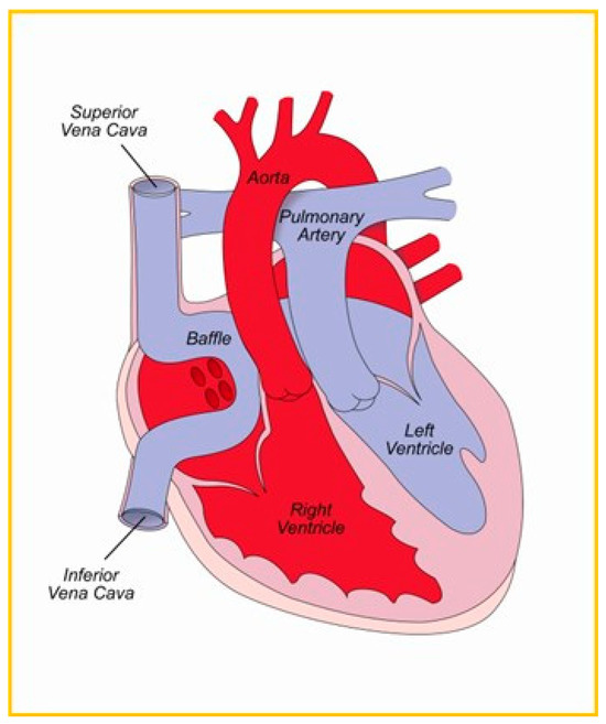 Adult Congenital Heart Disease in the Emergency Department
