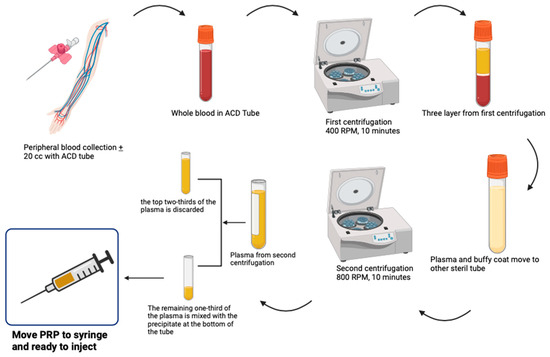 Clinical Outcome of Multiple Platelet-Rich Plasma Injection and ...