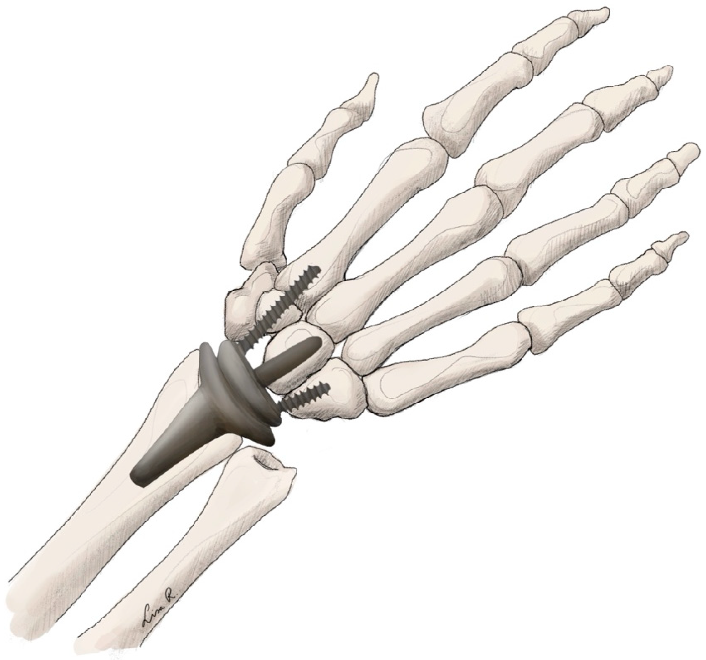 Carpal Implants in the Current Surgical Landscape: An Illustrated Overview