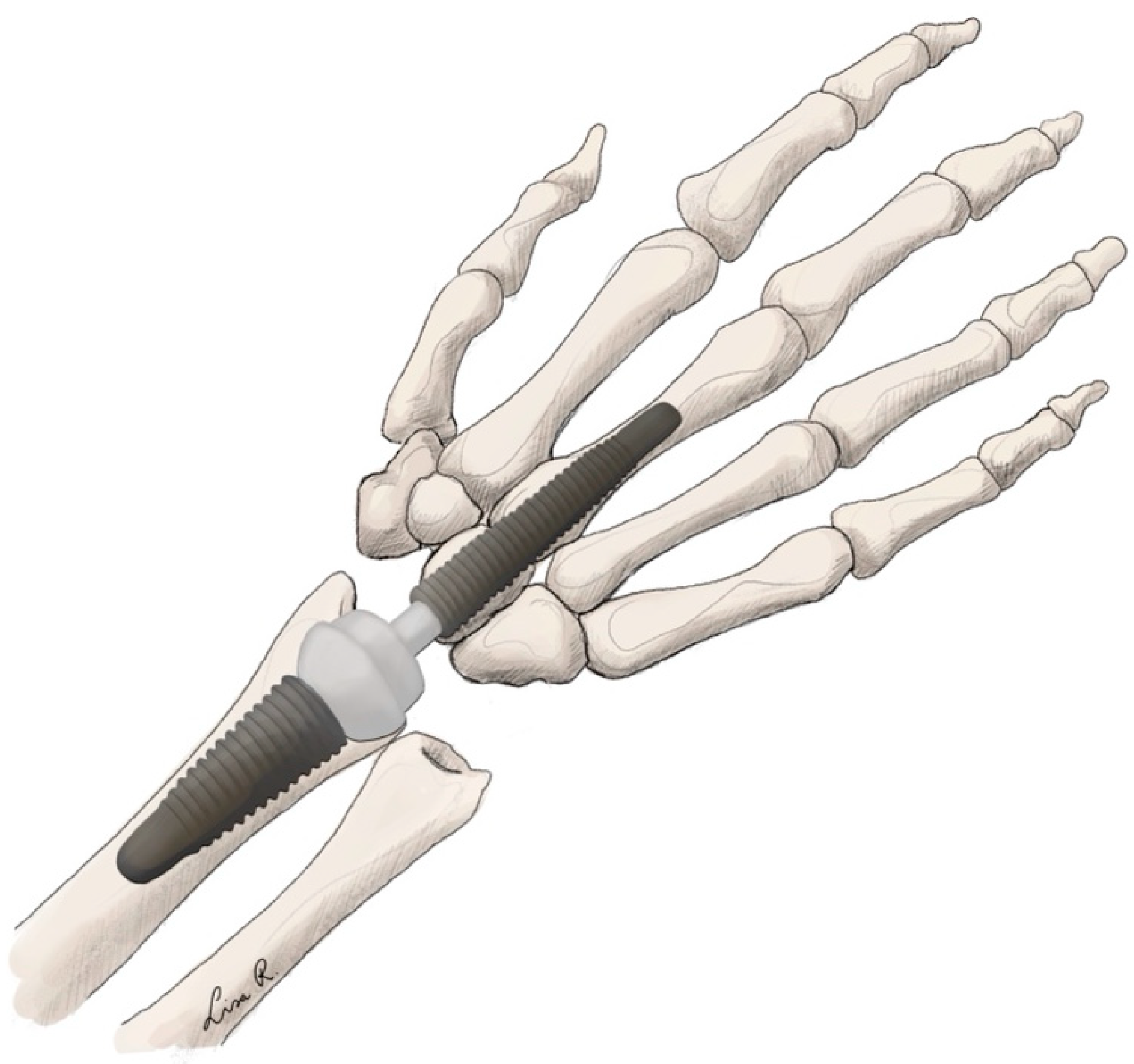 Carpal Implants in the Current Surgical Landscape: An Illustrated Overview