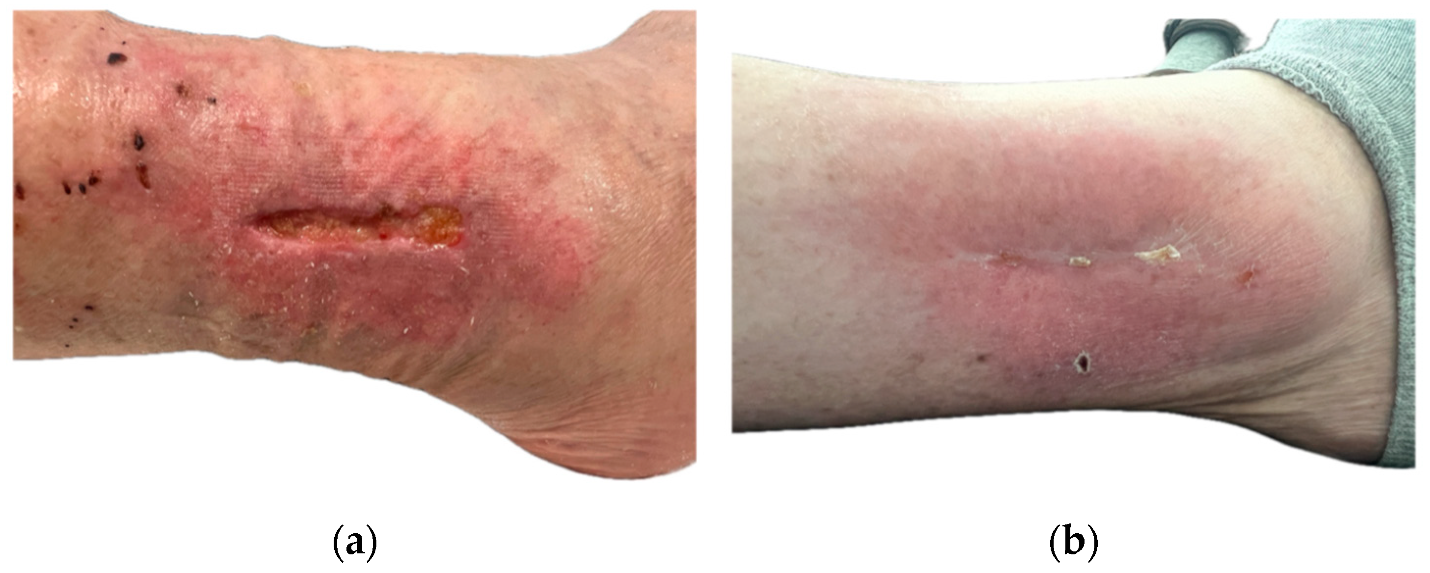Bioresorbable Polylactic Acid Matrix for Chronic Non-Healing Wounds ...