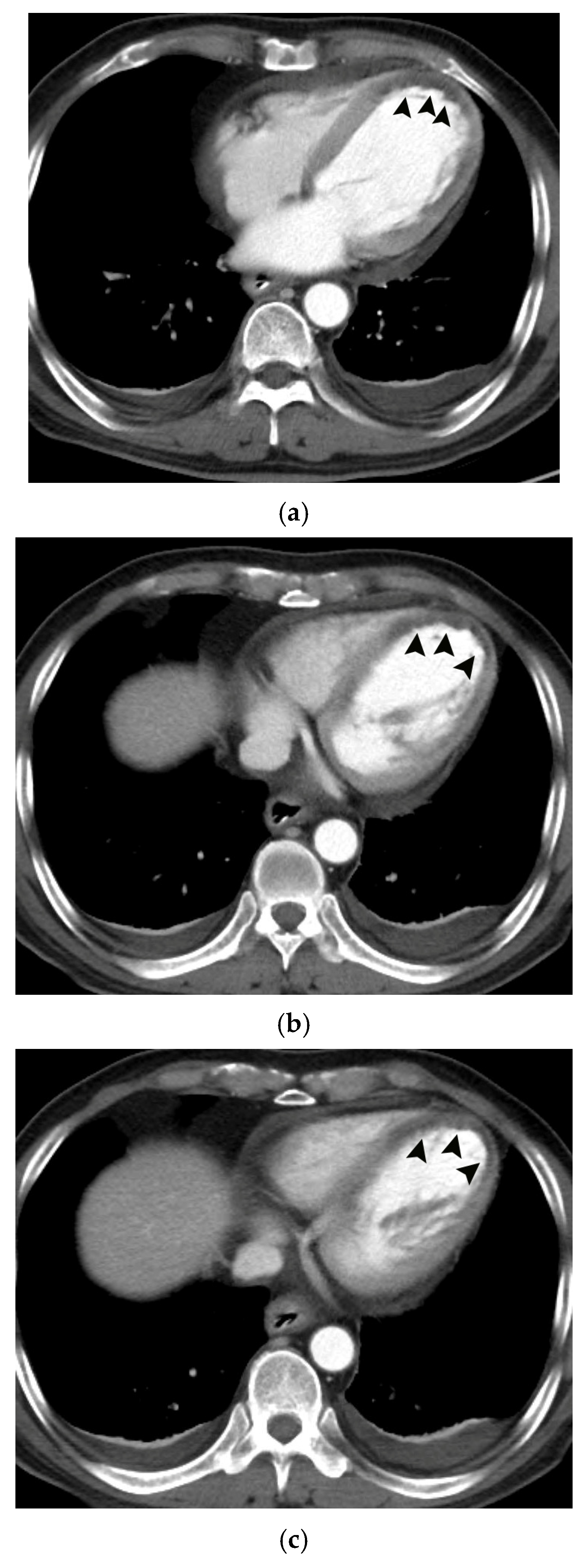 Overlooked Acute Myocardial Infarction and Intramural Hematoma on ...