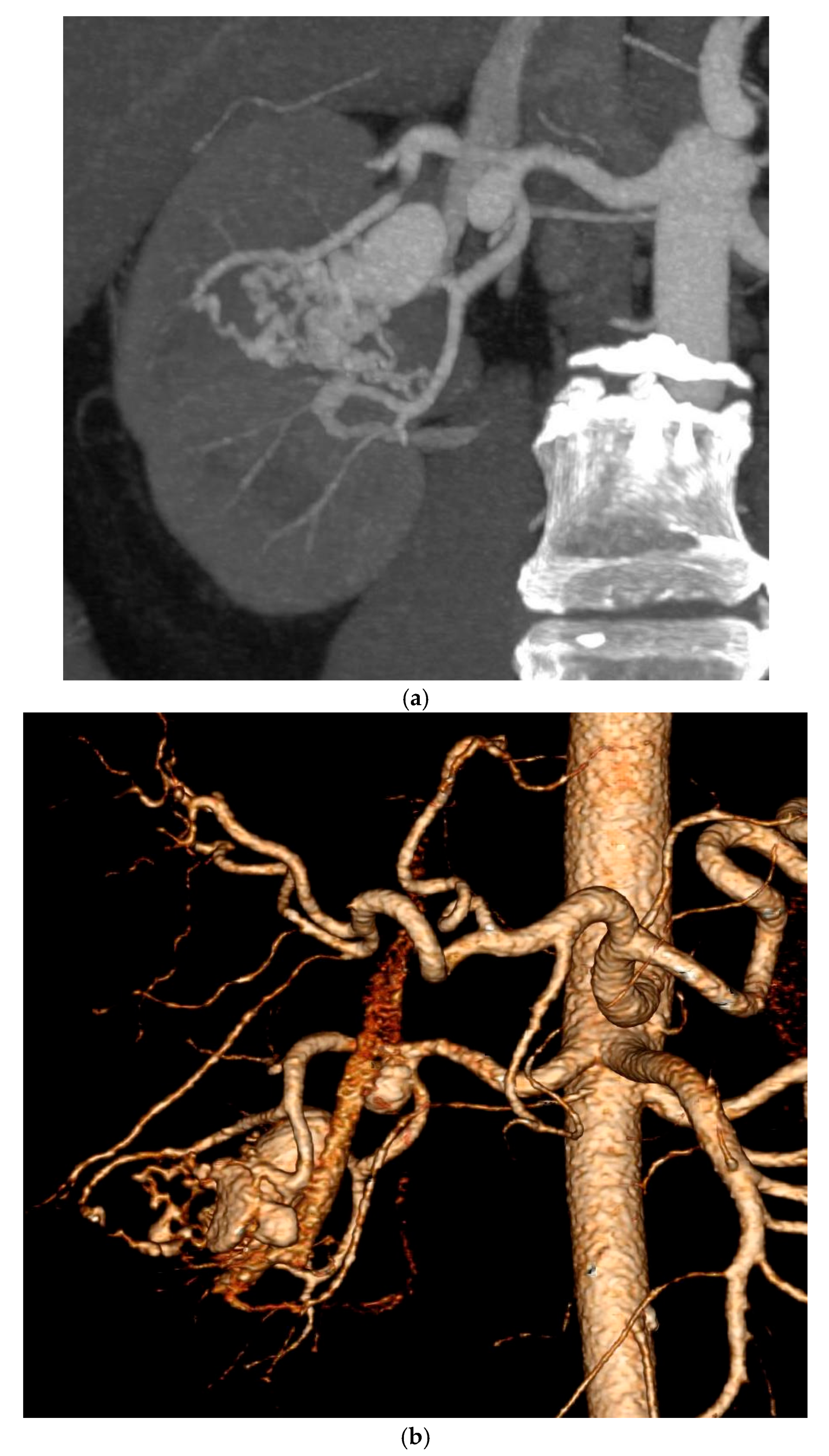 Resolution of Proteinuria After Renal AVM Embolization with Combined ...