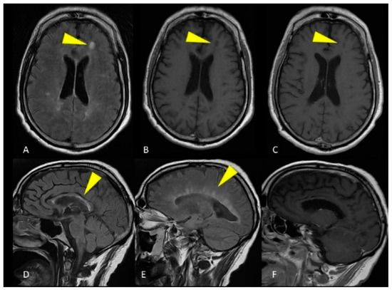 Magnetic Resonance Imaging of Autoimmune Demyelinating Diseases as a ...