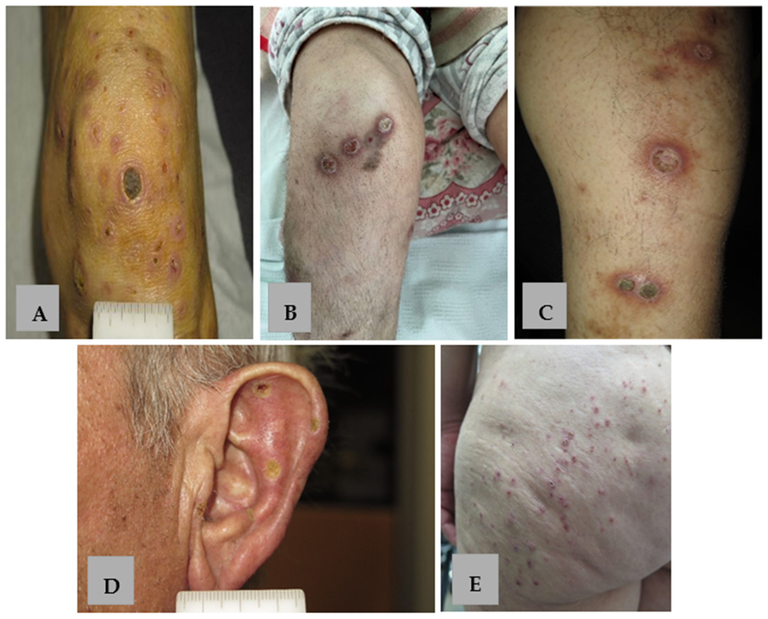 Dermoscopy of Acquired Perforating Dermatoses: A Case Series and Review ...