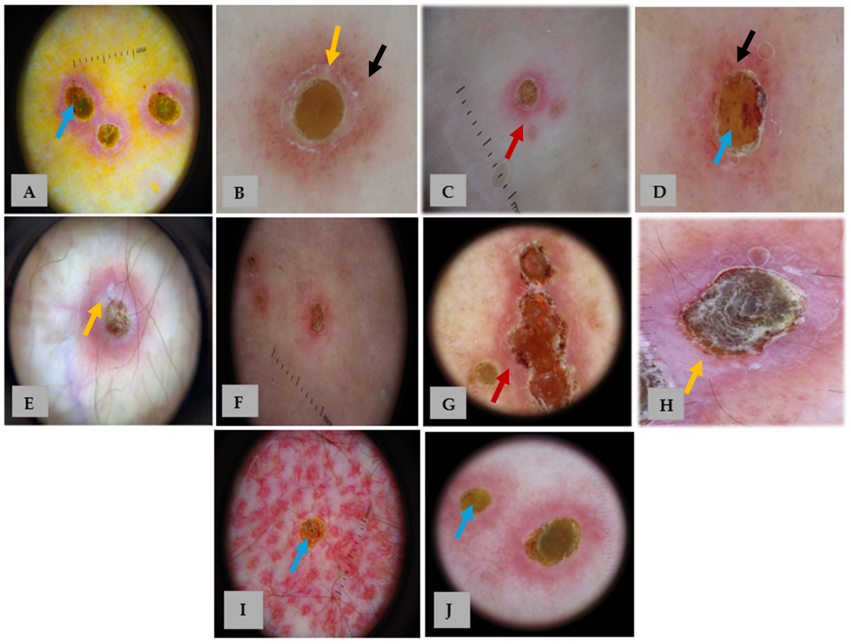 Dermoscopy of Acquired Perforating Dermatoses: A Case Series and Review ...