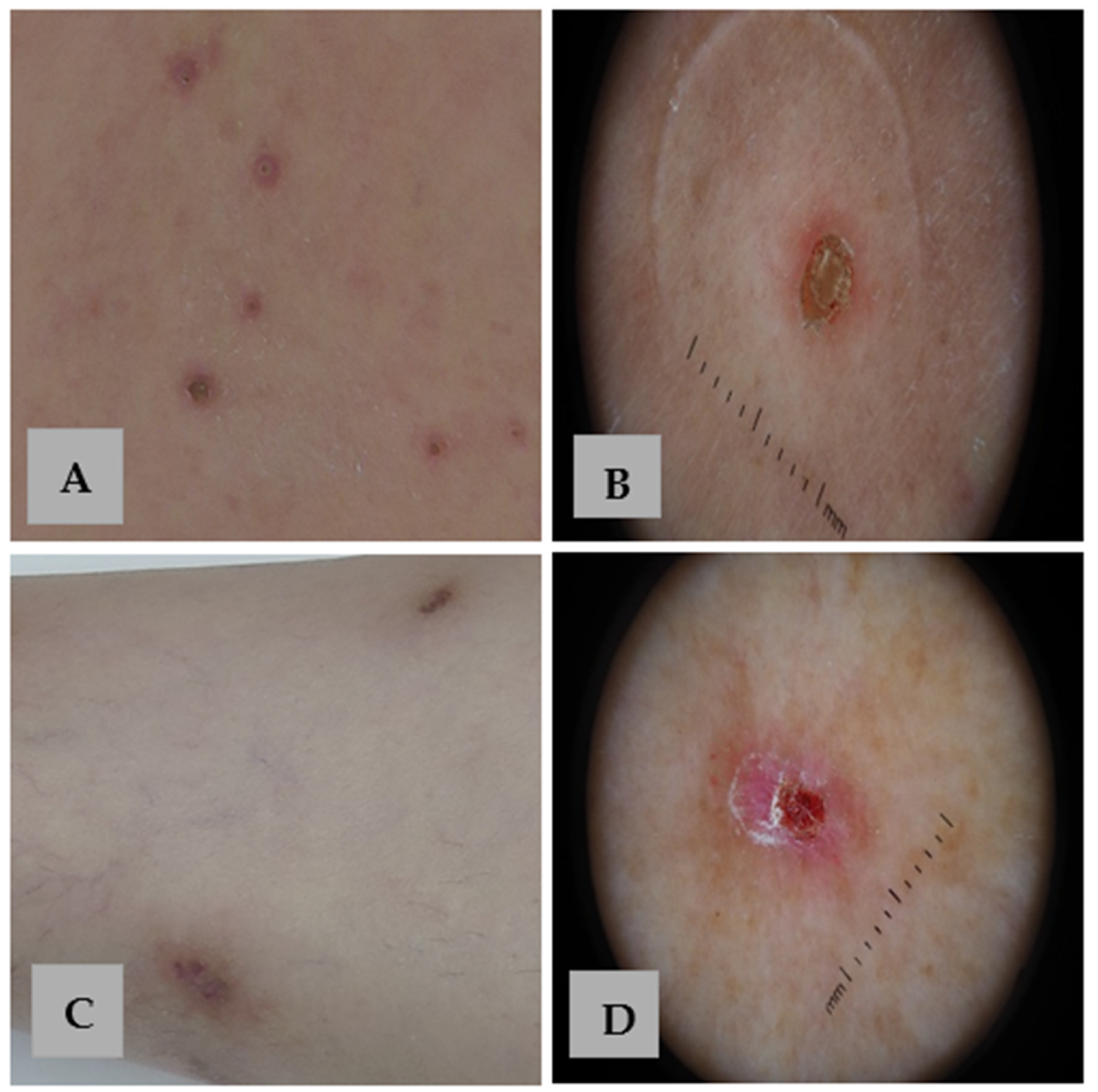 Dermoscopy of Acquired Perforating Dermatoses: A Case Series and Review ...