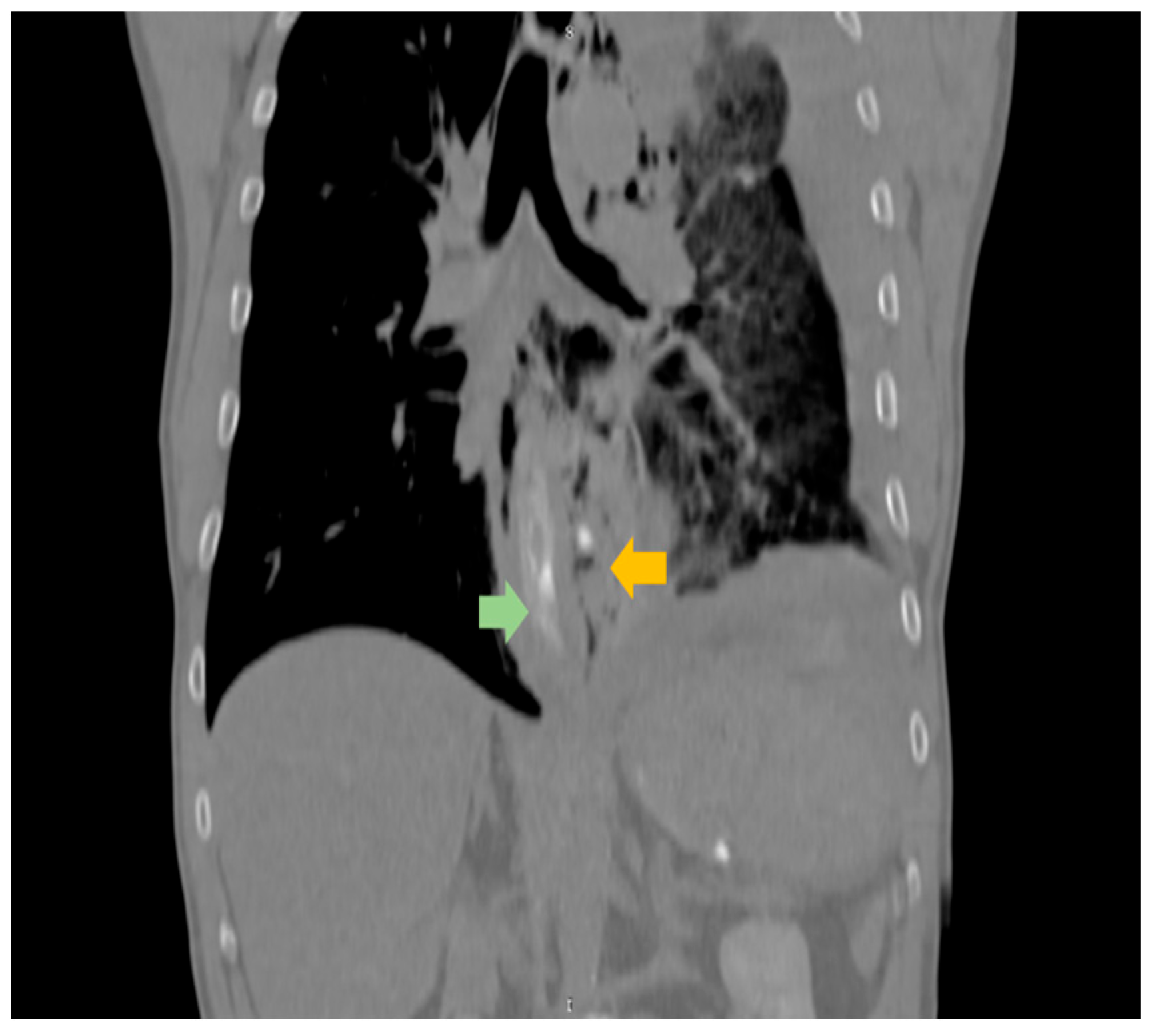 Laparoscopic Management of Boerhaave Syndrome: Case Series and ...