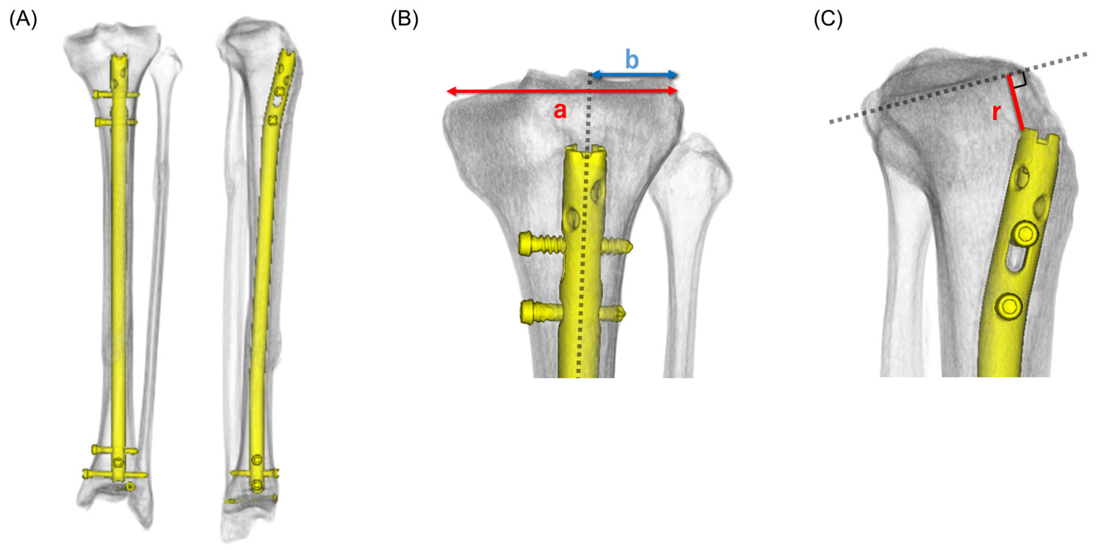 Comparison of Tibial Nail Entry Point Location Among Infrapatellar ...
