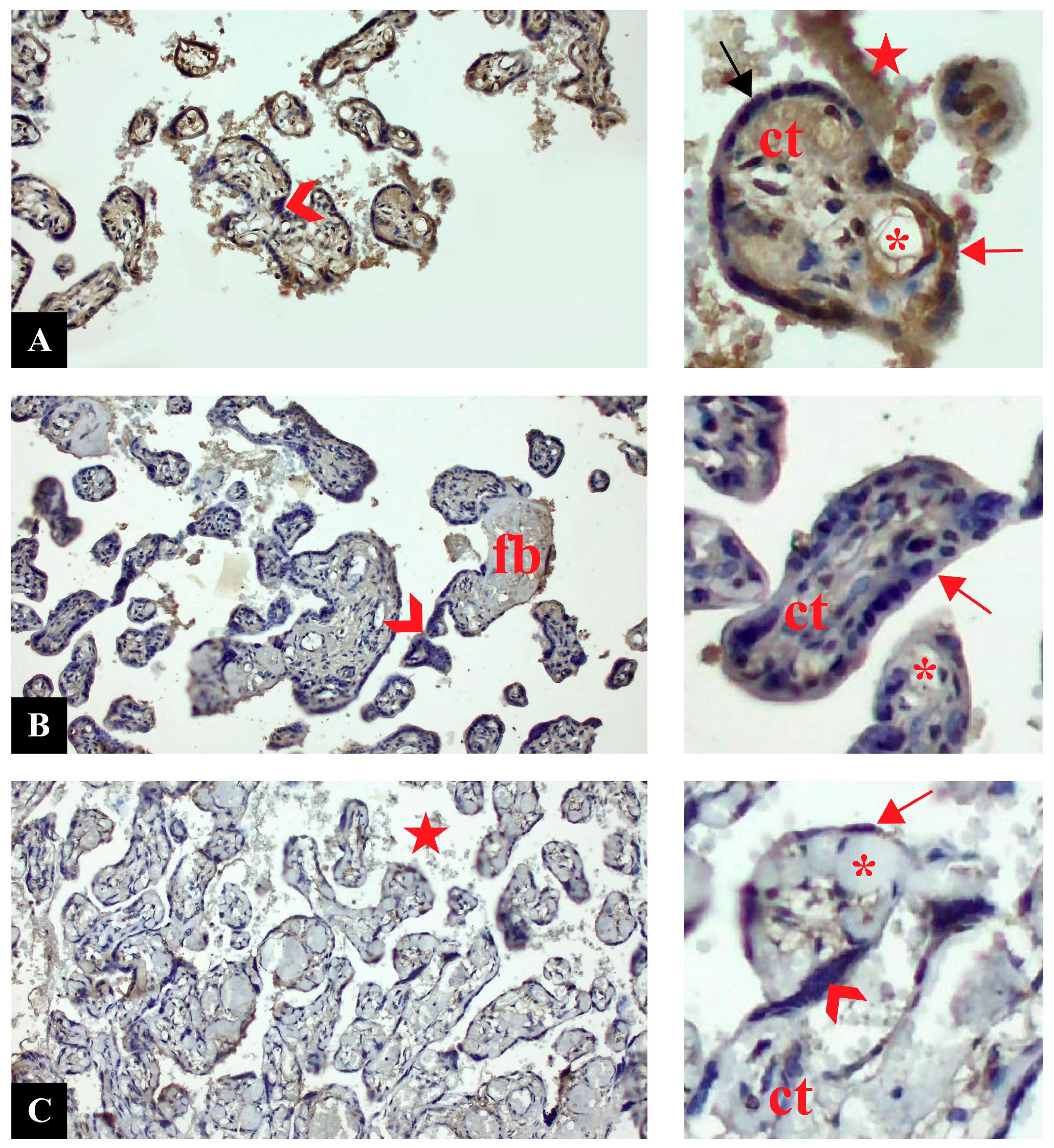 NRF1 and NRF2 Expression in Preeclamptic Placentas: A Comparative ...