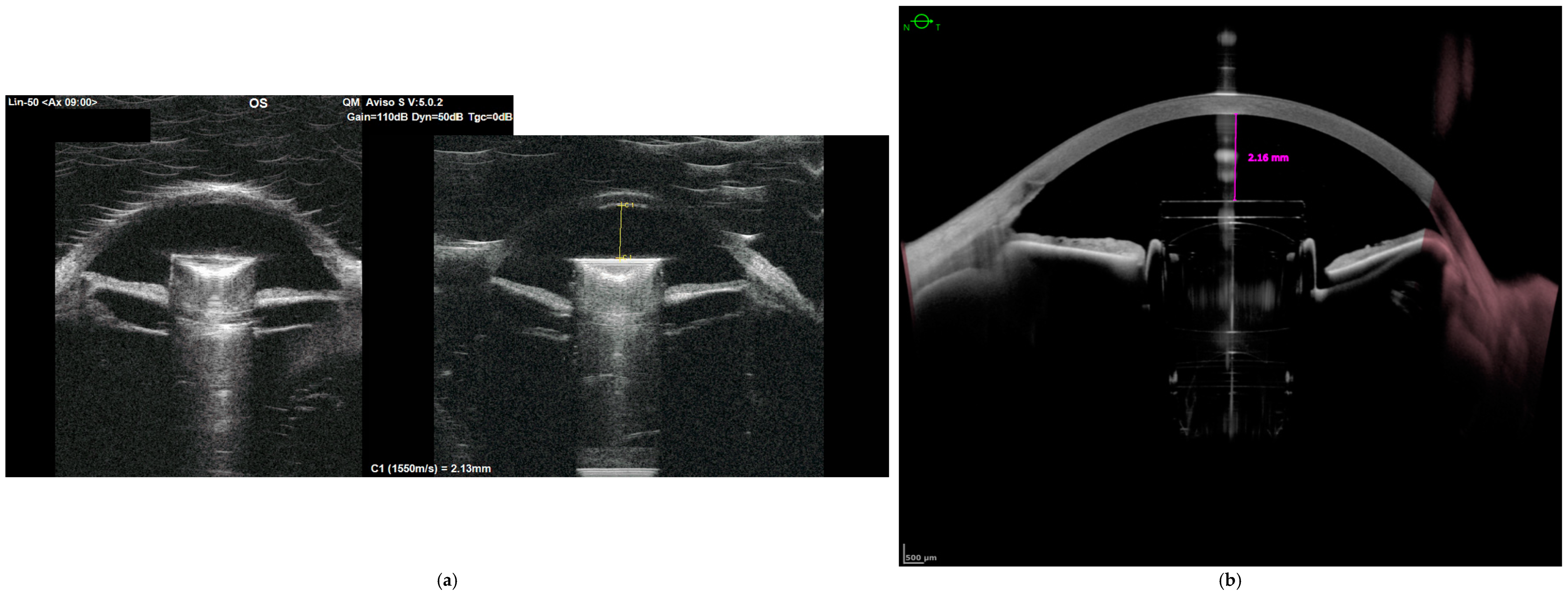 New Technique of Single-Point Scleral Fixation of the Smaller-Incision ...