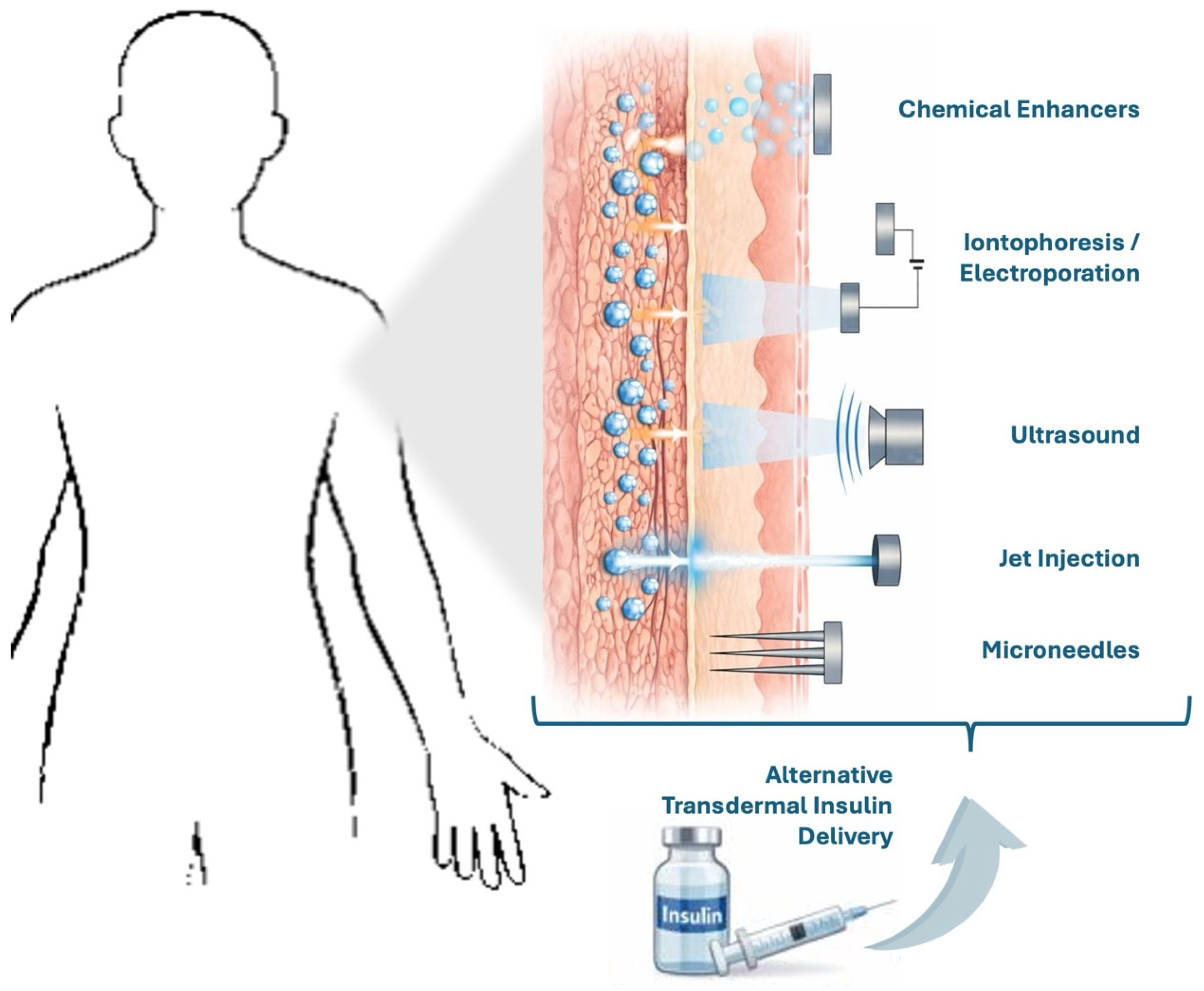 Advances in Insulin Delivery: Transdermal and Needle-Free Technologies ...