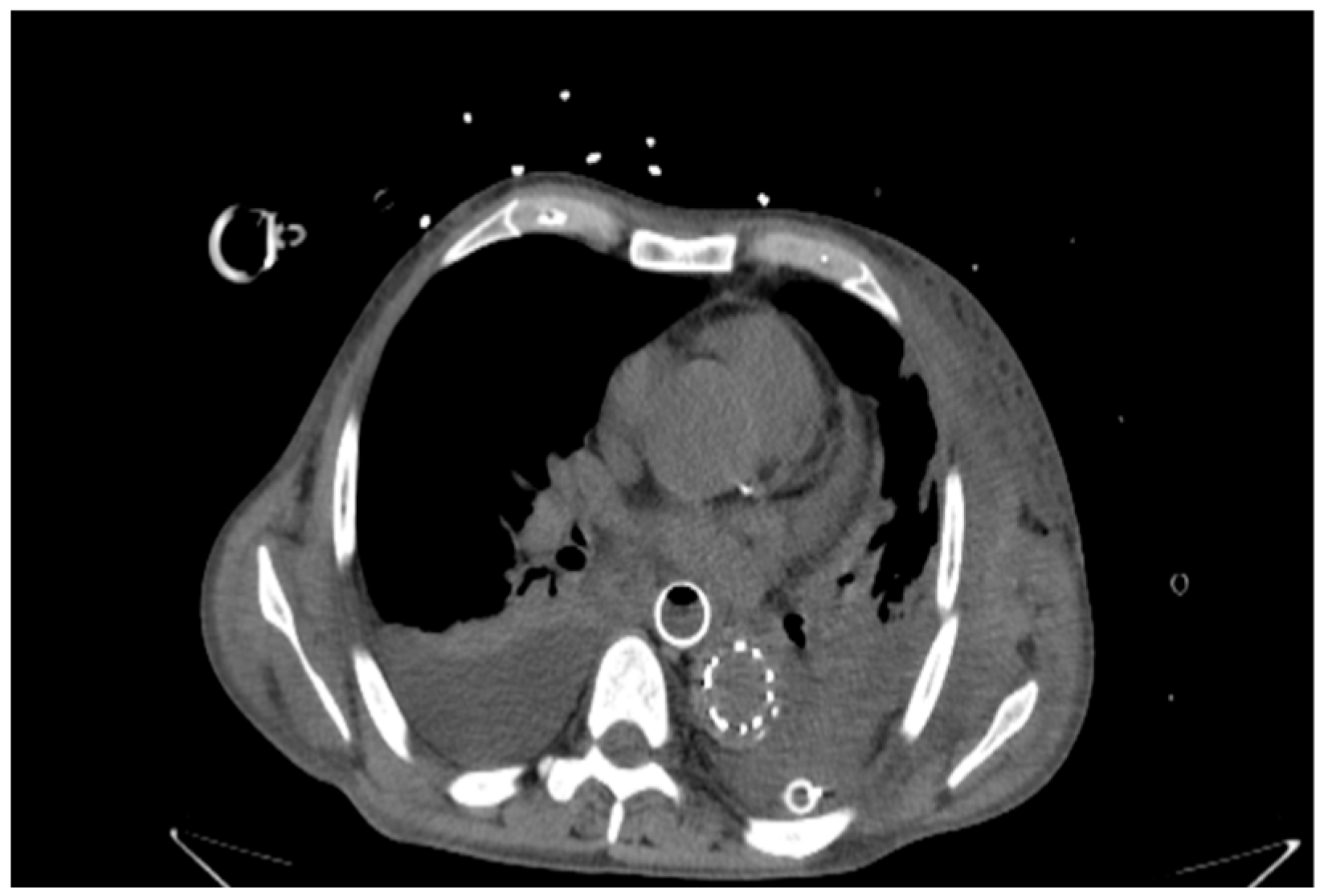 EndoVAC Therapy for Post-TEVAR Secondary Esophageal Fistula: A Rare ...