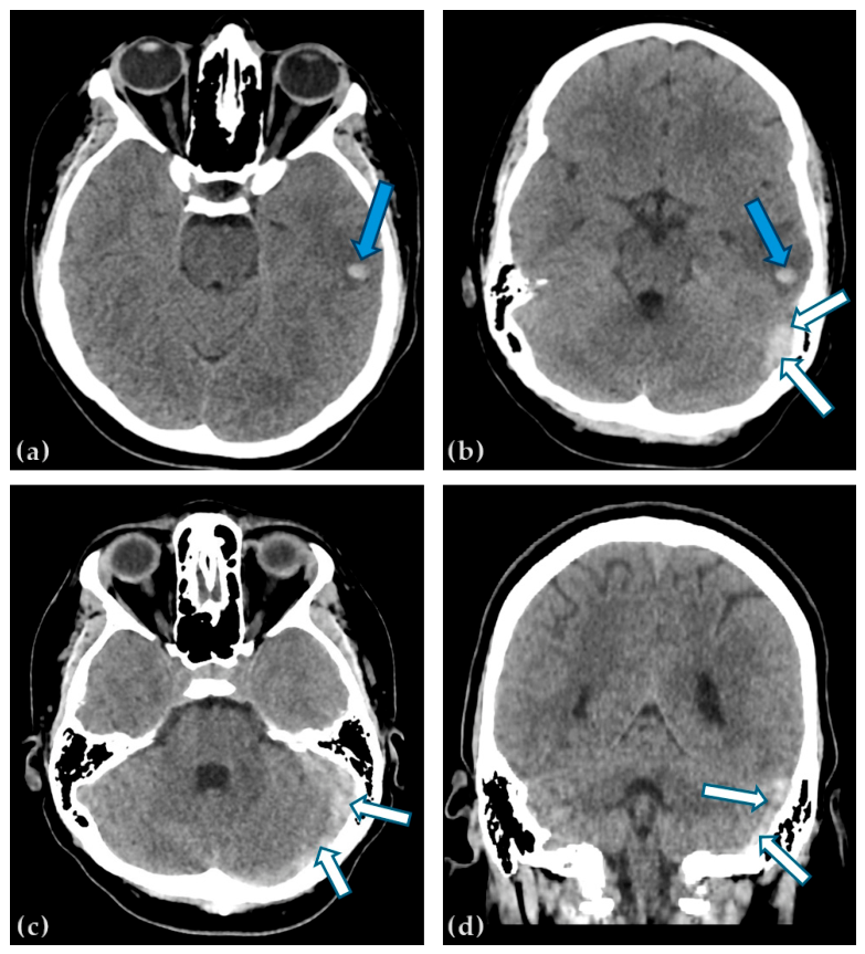 Conduction Aphasia in a Case of Left Cortical Veins and Left Lateral ...