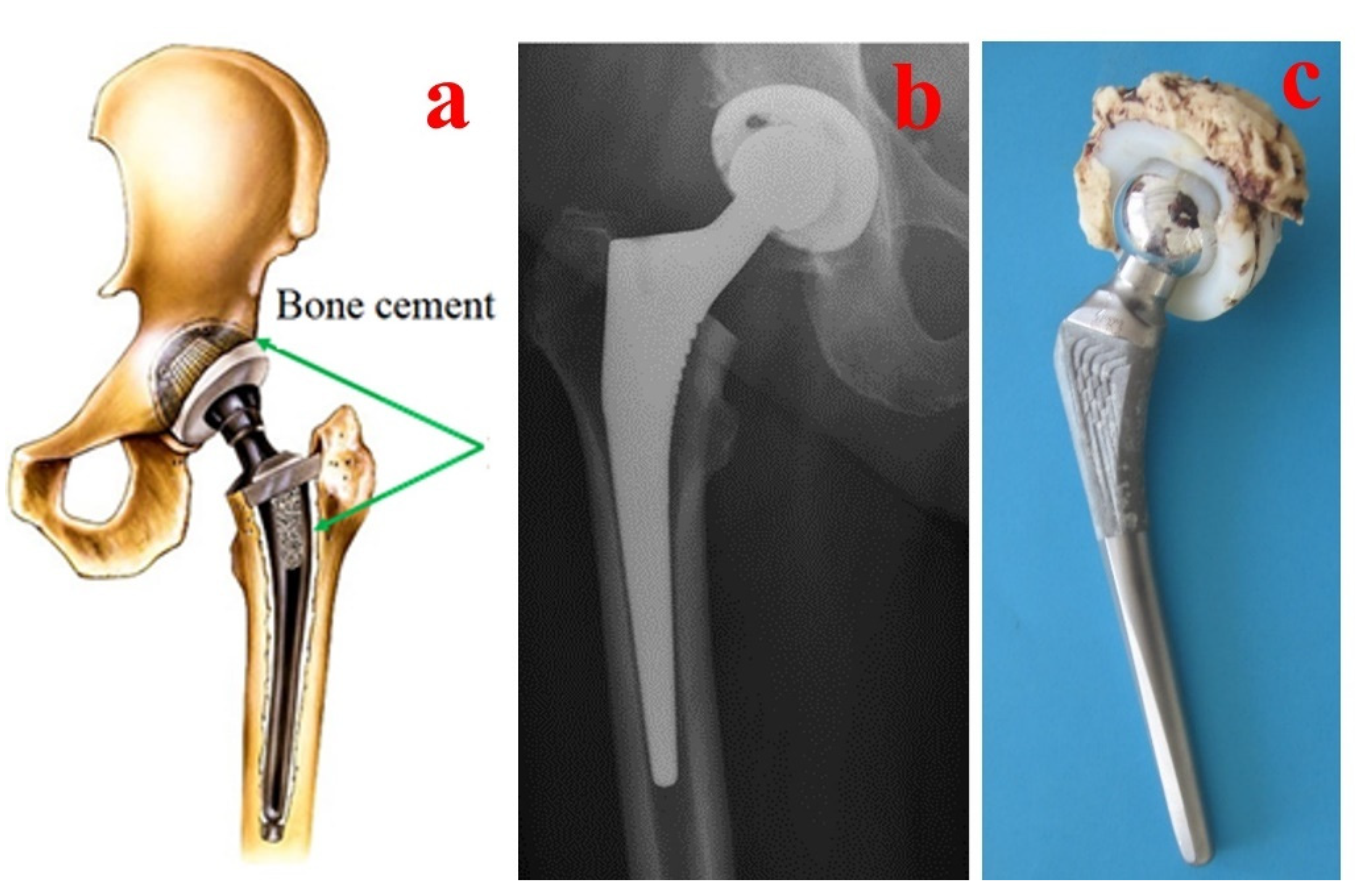 Materials Free Full Text Bone Cements Used For Hip Prosthesis Materials Free Full Text Bone Cements Used For Hip Prosthesis