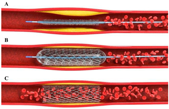 Surface Engineering of Bioactive Coatings for Improved Stent ...