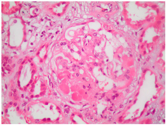 Pathogenesis and Management of Acute Kidney Injury in Patients with ...