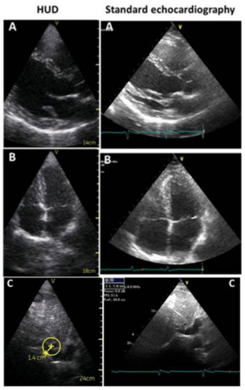 Handheld Ultrasound and Focused Cardiovascular Echography: Use and ...